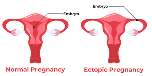 Ectopic Pregnancy: Symptoms, Causes, and Treatments
