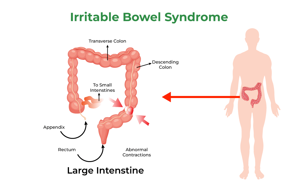 Irritable Bowel Syndrome Stool