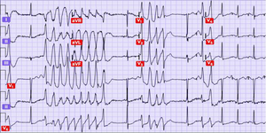 Difference Between Polymorphic and Monomorphic Ventricular Tachycardia ...