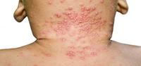 Difference Between Impetigo and Herpes - GeeksforGeeks