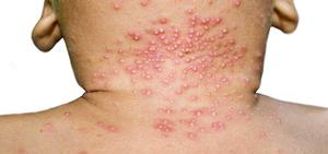 Difference Between Impetigo and Herpes - GeeksforGeeks