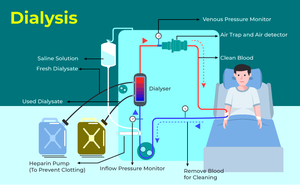 Dialysis - Definition, Procedure, Types, Principle and Side Effects ...