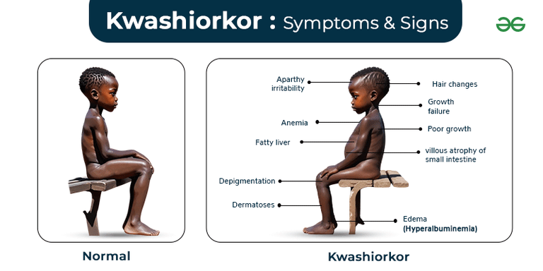 Kwashiorkor - An Overview - GeeksforGeeks