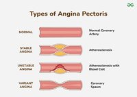 Angina Pectoris - GeeksforGeeks