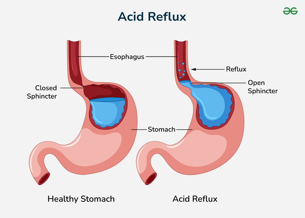 Acidity GeeksforGeeks