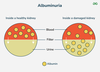 Albumin in Urine | GeeksforGeeks