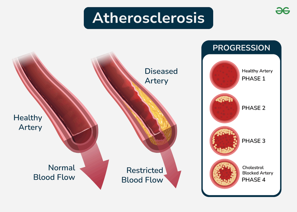 Symptoms of Arteriosclerosis - Types and Treatment | GeeksforGeeks