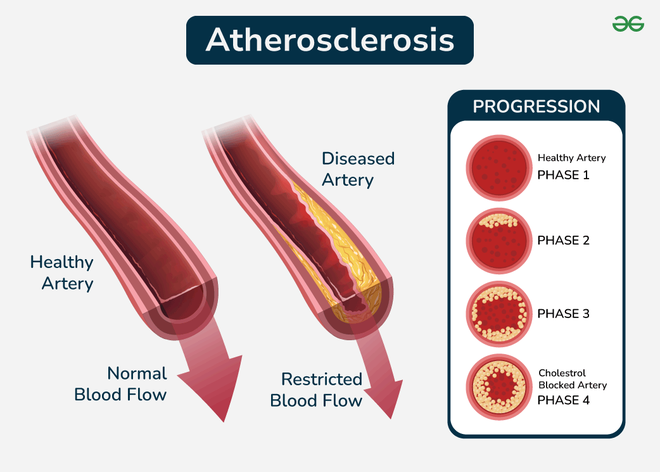 Symptoms of Arteriosclerosis - Types and Treatment | GeeksforGeeks