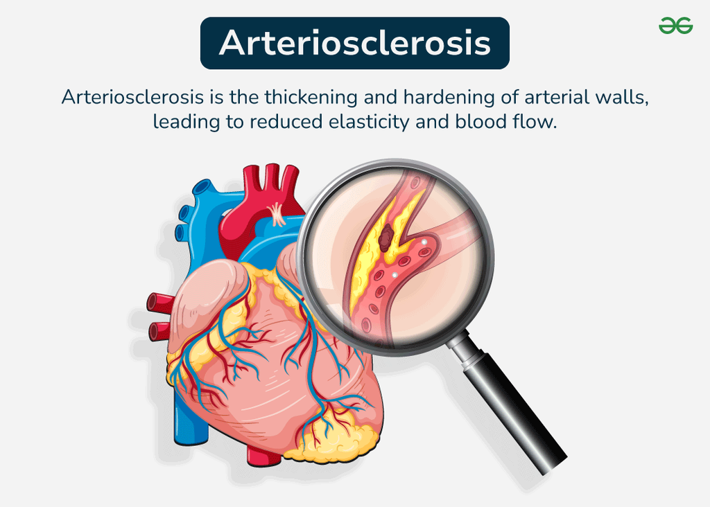 Symptoms of Arteriosclerosis - Types and Treatment | GeeksforGeeks